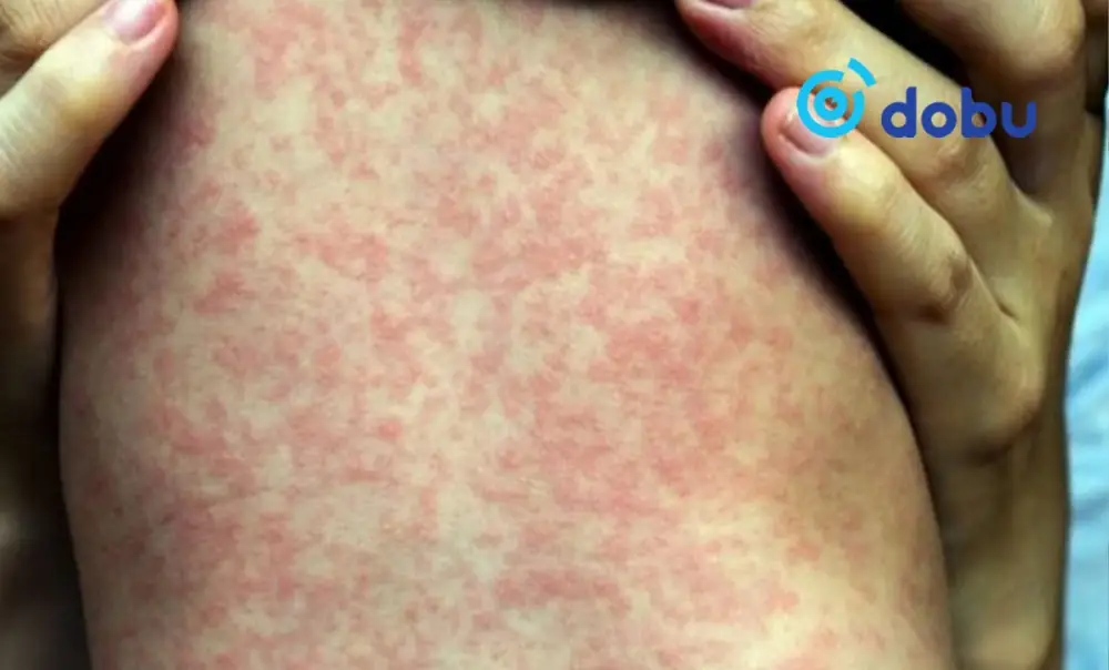 Улаанбурхан өвчний тохиолдол 800 хүрлээ - dobu.mn